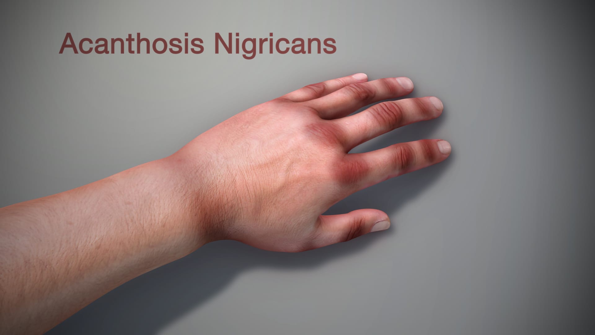 Acanthosis Nigricans