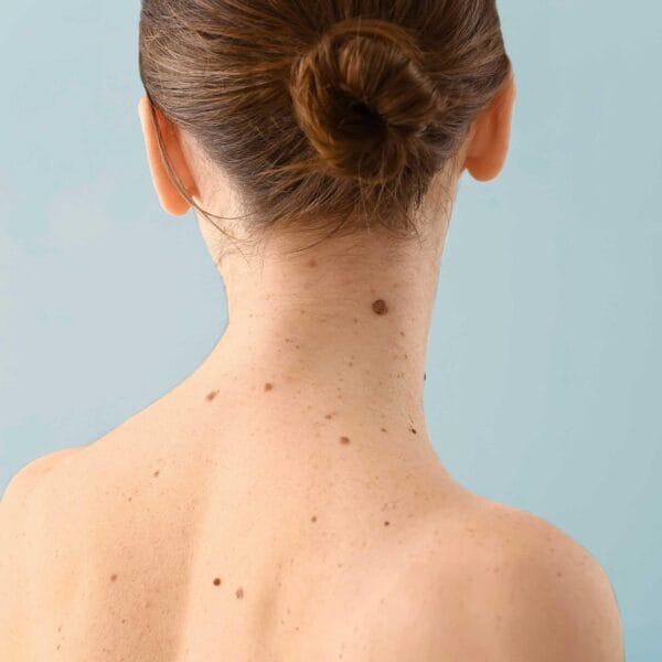Skin Tag Removal